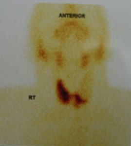 Isotope scan of the Thyroid